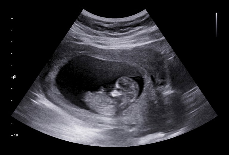 Baby view rgv – 3D 4D Ultrasounds in the Rio Grande Valley